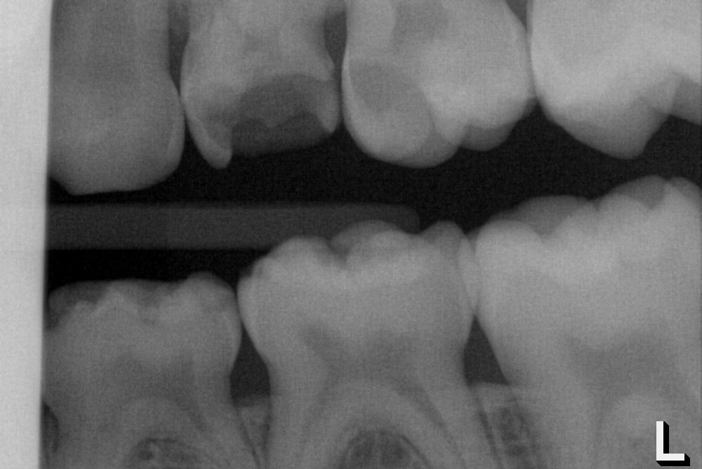 Teeth Detection Object Detection Dataset By Treatment Planning Project