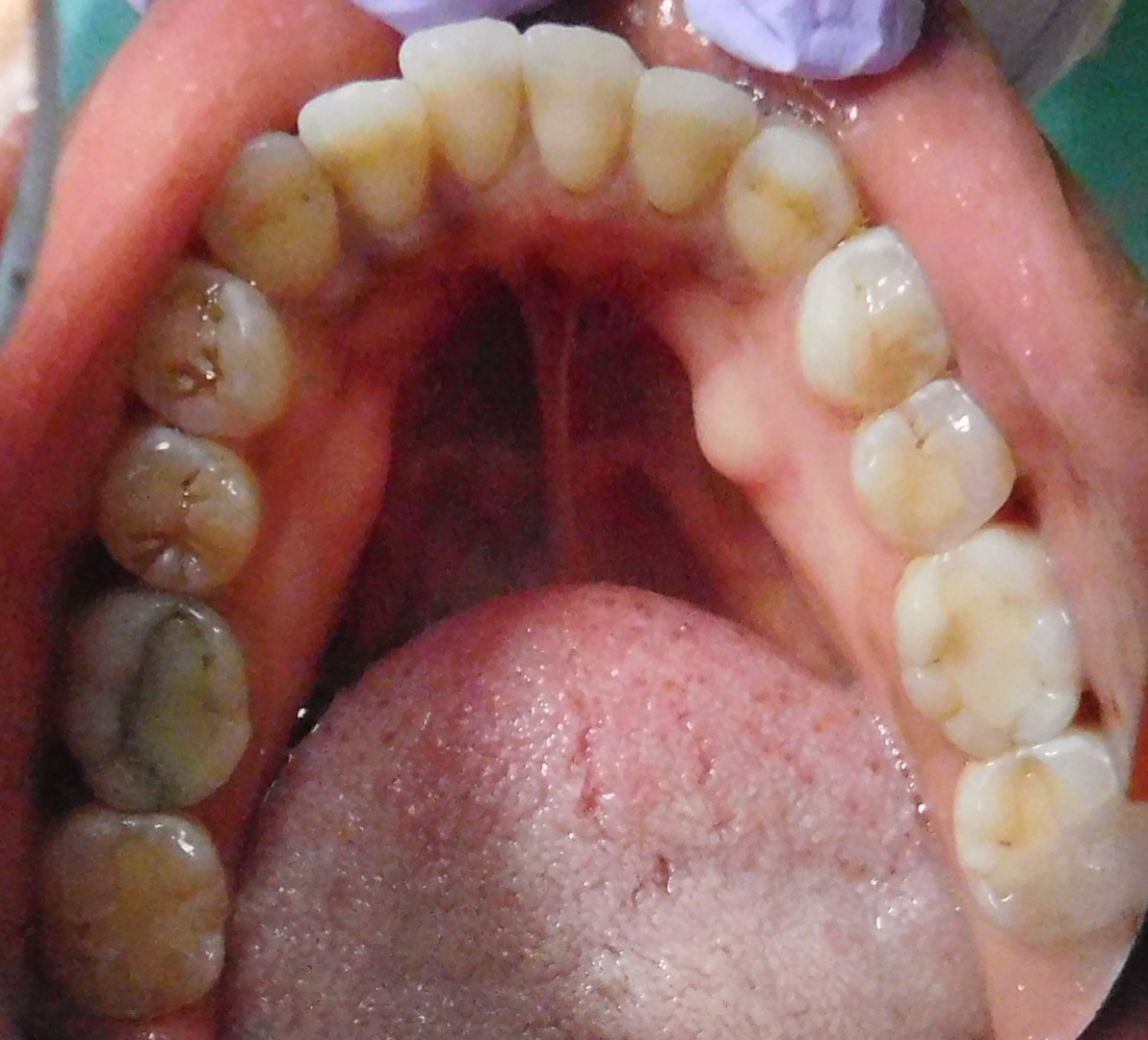 How to Use the Occlusal caries detection Object Detection API