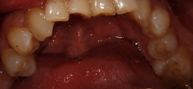 Occlusal Caries Detection Object Detection Dataset V2 2023 01 19 4