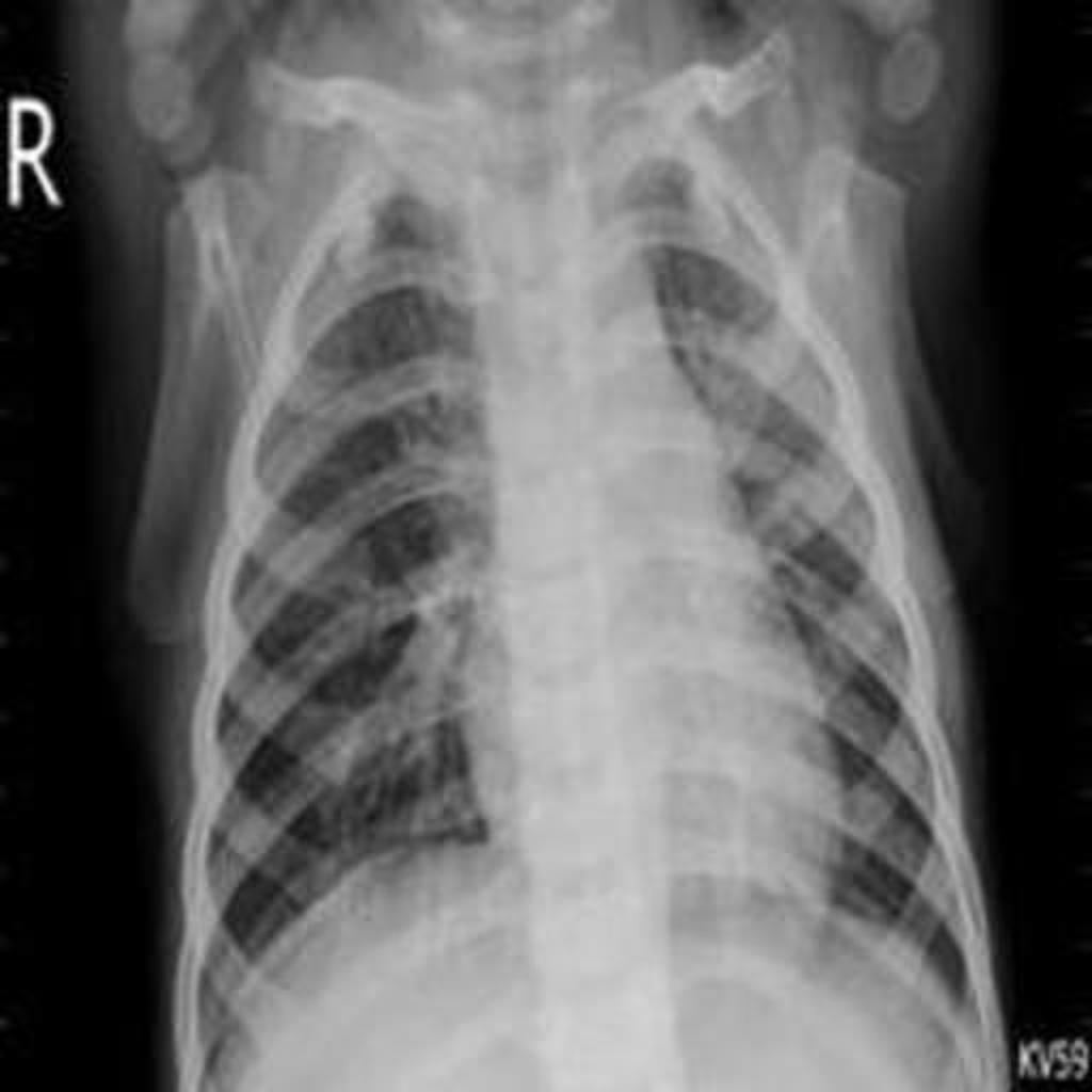 X-ray Images Classification Dataset by visiontransformer