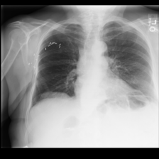 How to Use the object-detection-chest-x-ray Object Detection API