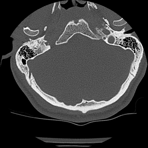 Domain Knowledge vs AI: Detecting Cervical Spine Fractures from CT ...
