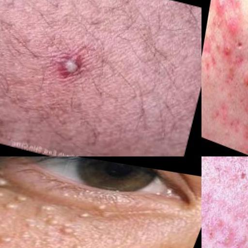 Acne detection Classification Dataset and Pre-Trained Model by Bangkit ...