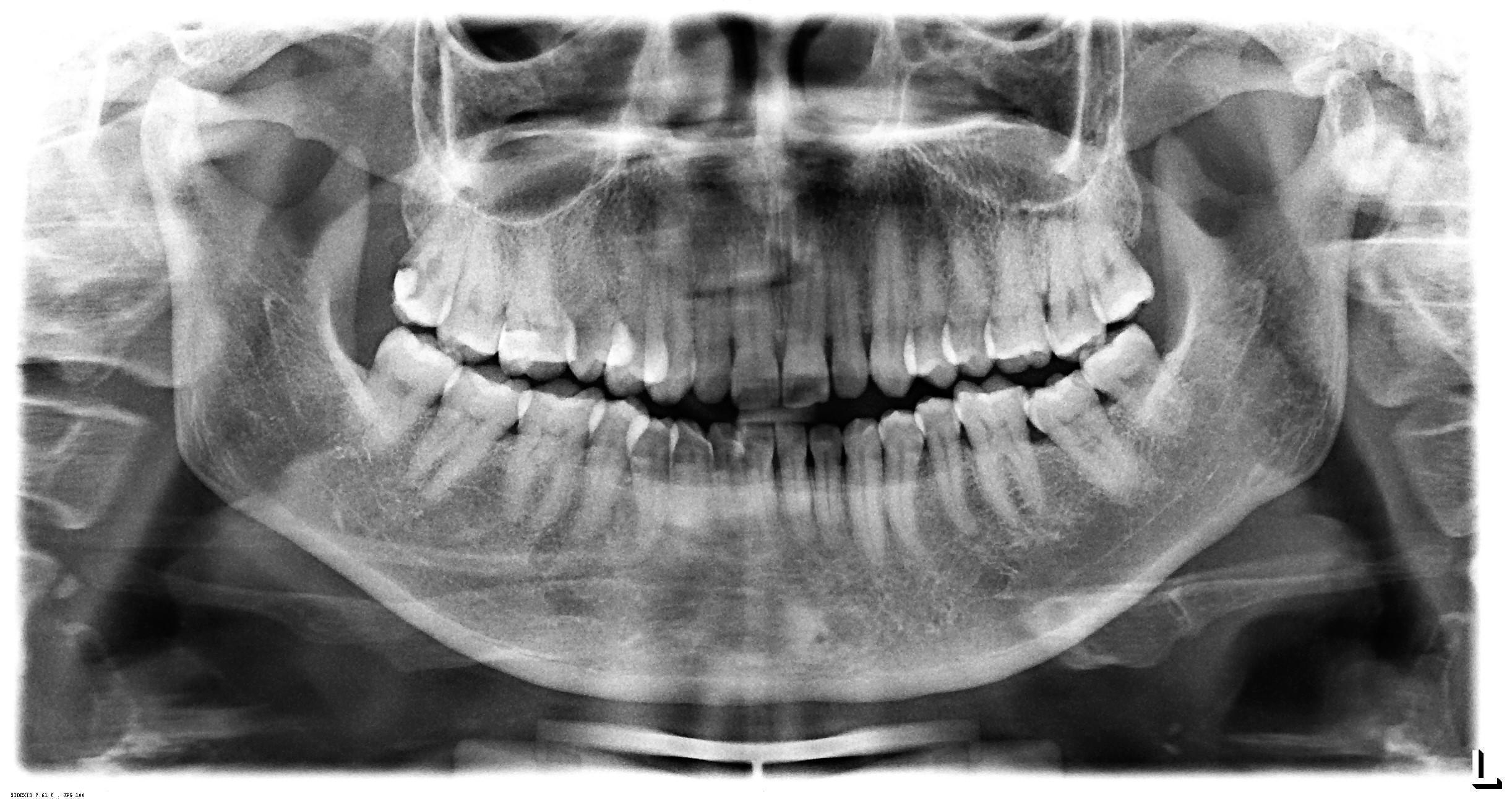 Teeth Instance Segmentation Instance Segmentation Dataset And Pre