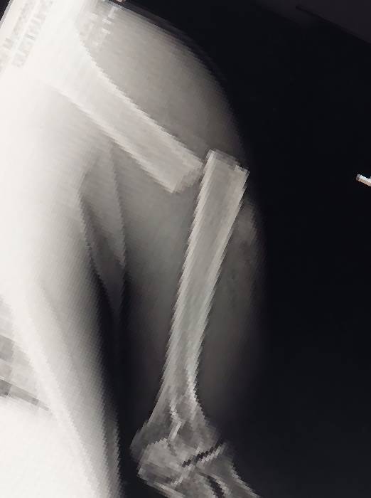 Humerus_Segmentation Semantic Segmentation Dataset by HumerusSegmentation