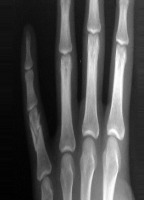 Bone fracture detection Object Detection Dataset and Pre-Trained Model ...