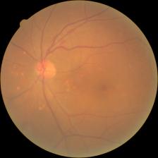 Eye Disease Classification Dataset and Pre-Trained Model by Student