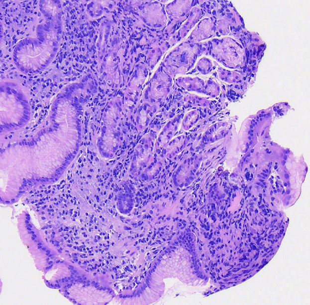 YOLOv8 Inflammation Detection Object Detection Dataset and Pre-Trained Model by YOLOv8