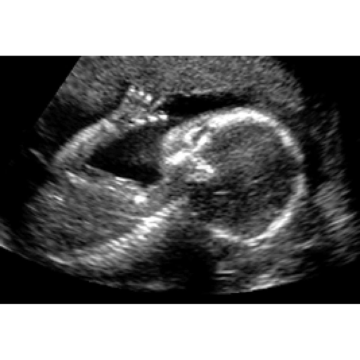 How To Use The Fetus Detection Object Detection Api