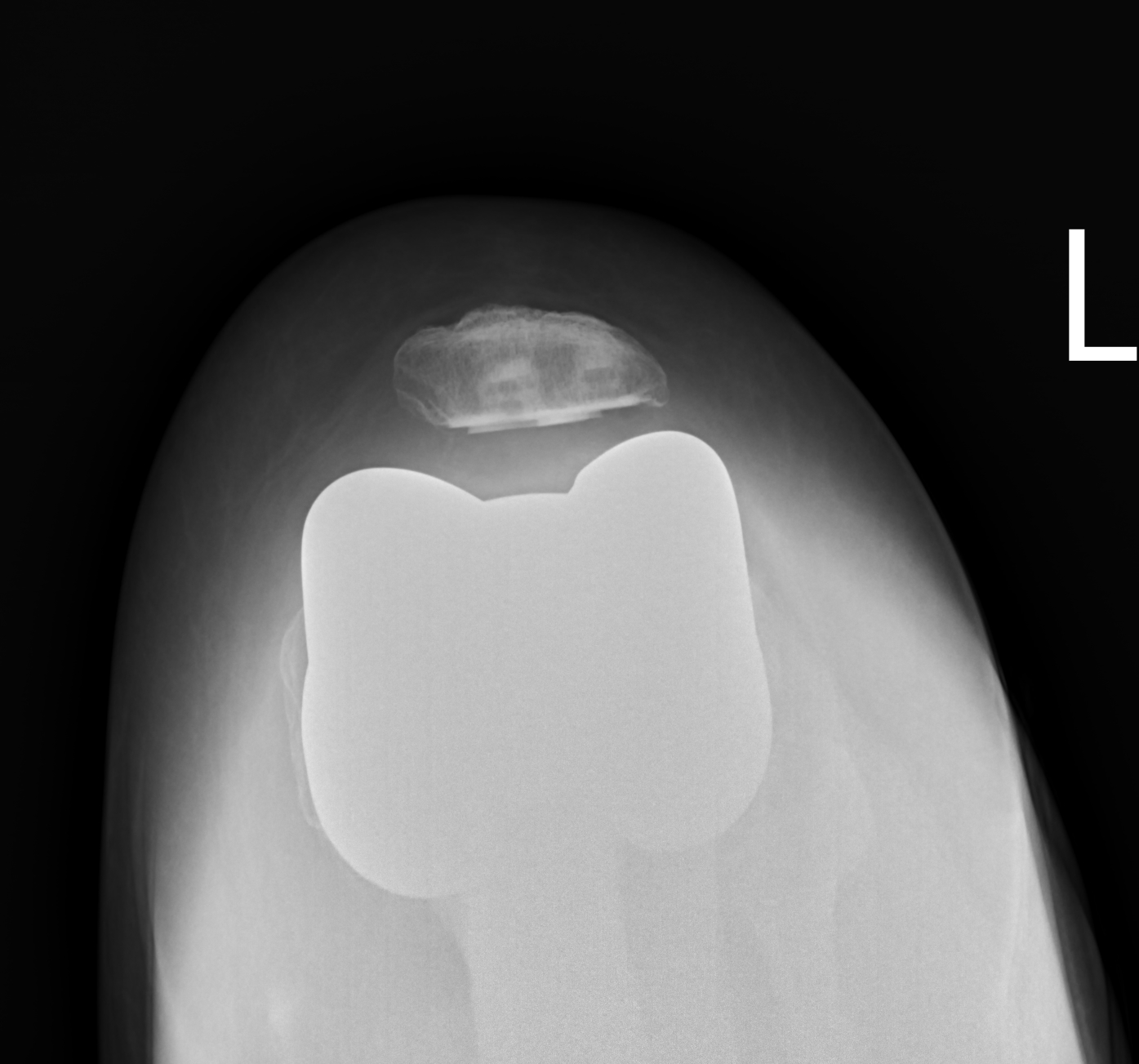 Total Joint Replacement Model Classification Dataset by Orthopaedics NU
