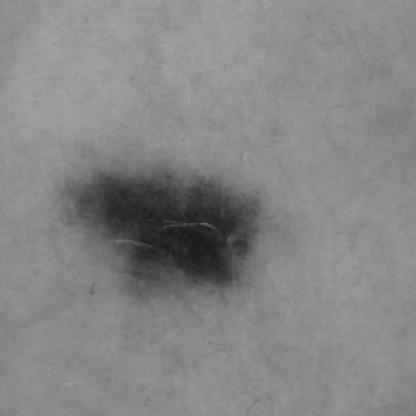 skin cancer Object Detection Dataset by Binali Yldrm niversitesi