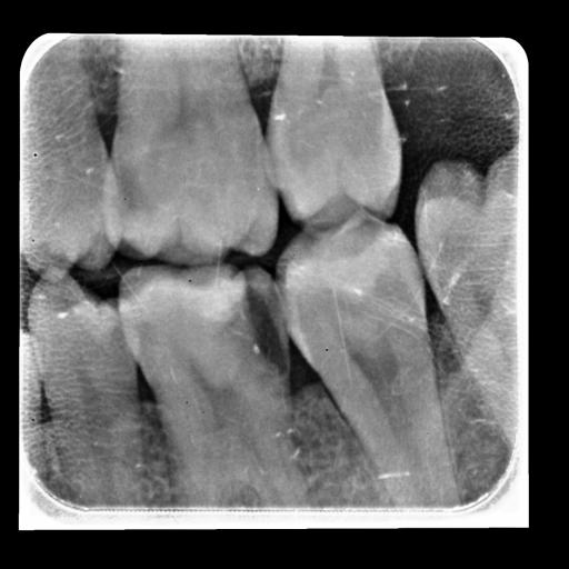tooth_sol_150 Instance Segmentation Dataset by Thammasart University