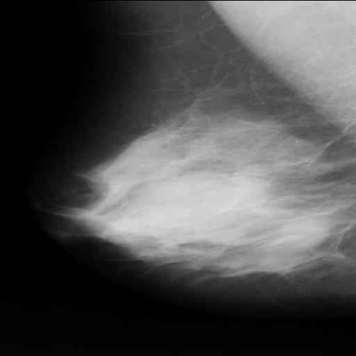 Abnormal Mammogram Object Detection Dataset And Pre Trained Model By Airlangga University