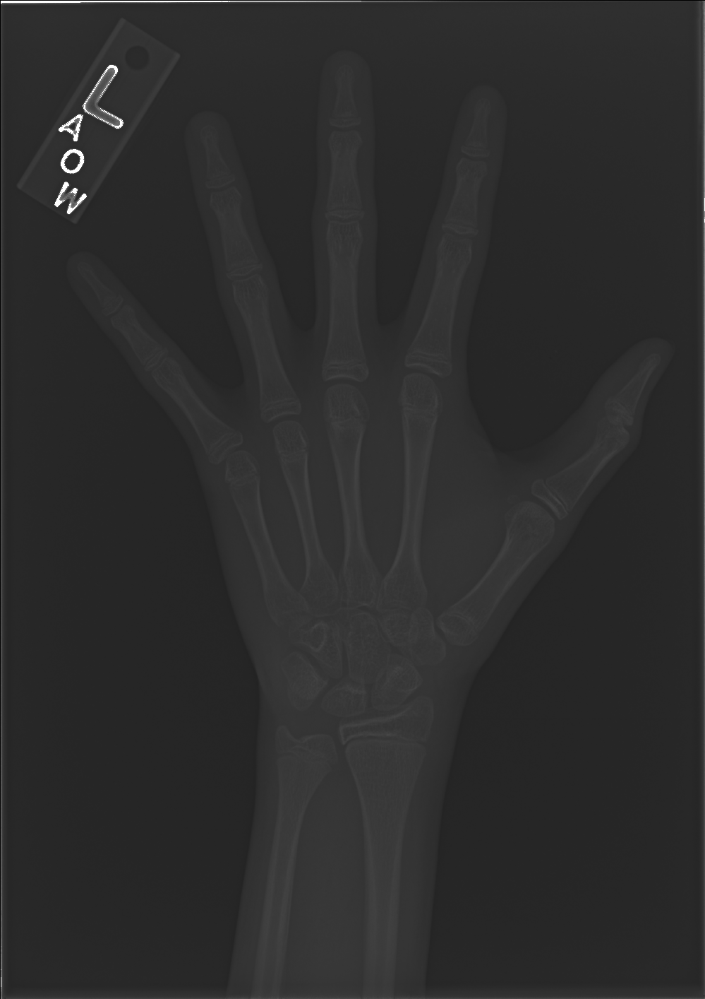 Hand-bones Instance Segmentation Dataset by Yolo