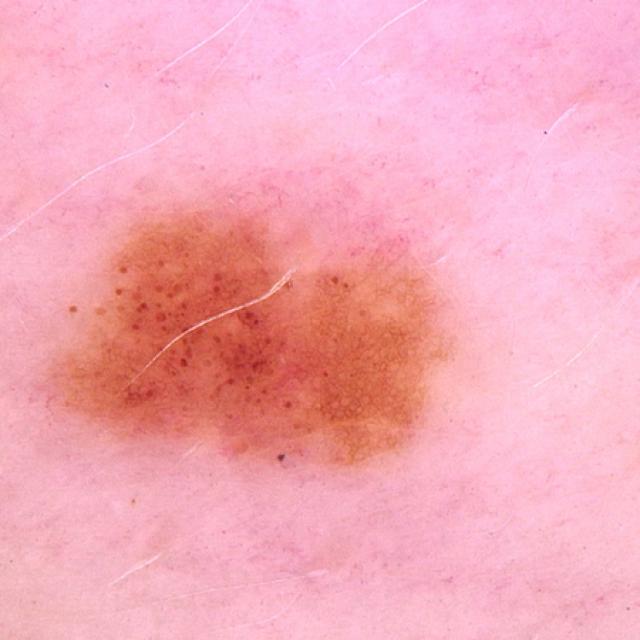 skin-cancer Classification Dataset by Burak Yilmaz